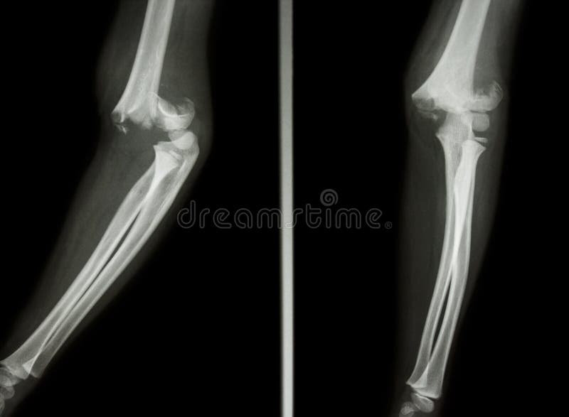 Supracondylar Humerus Fracture Stock Image - Image of human, orthopedic ...