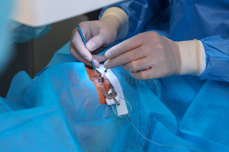 Surgeon Conducting Delicate Eye Surgery with Precision Tools Stock ...