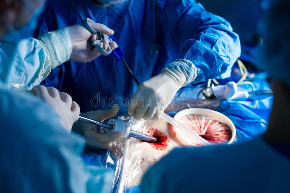 Surgeons Operate with Laparoscopic Manipulators Using Trocars Stock ...