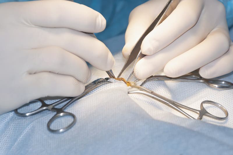 Surgery. Hands of a Surgeon in the Process of Work Stock Photo - Image ...