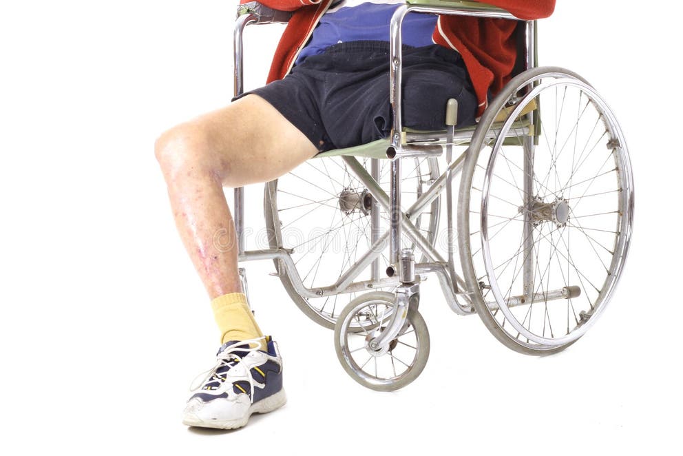 After Surgery Leg Amputation Stock Image - Image of husband, love: 3979909