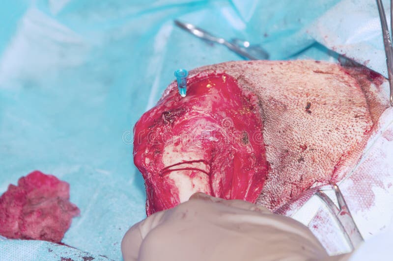 Surgery with Osteotomy of the Leg. Cutting the Angle of Bones Concept ...
