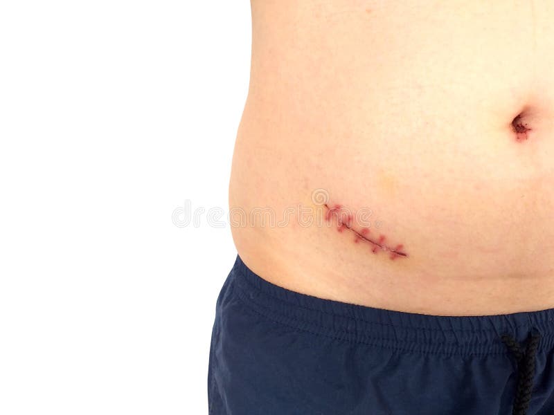 Surgery Wound from Appendix Removal Operation Isolated on White ...