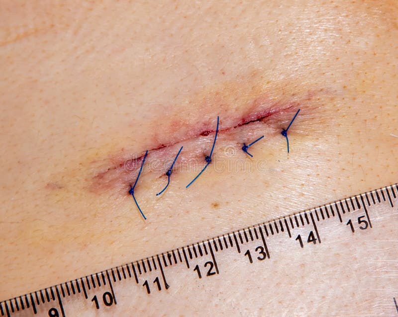 Surgical Cosmetic Suture Skin Surgery Stock Photos - Free & Royalty ...