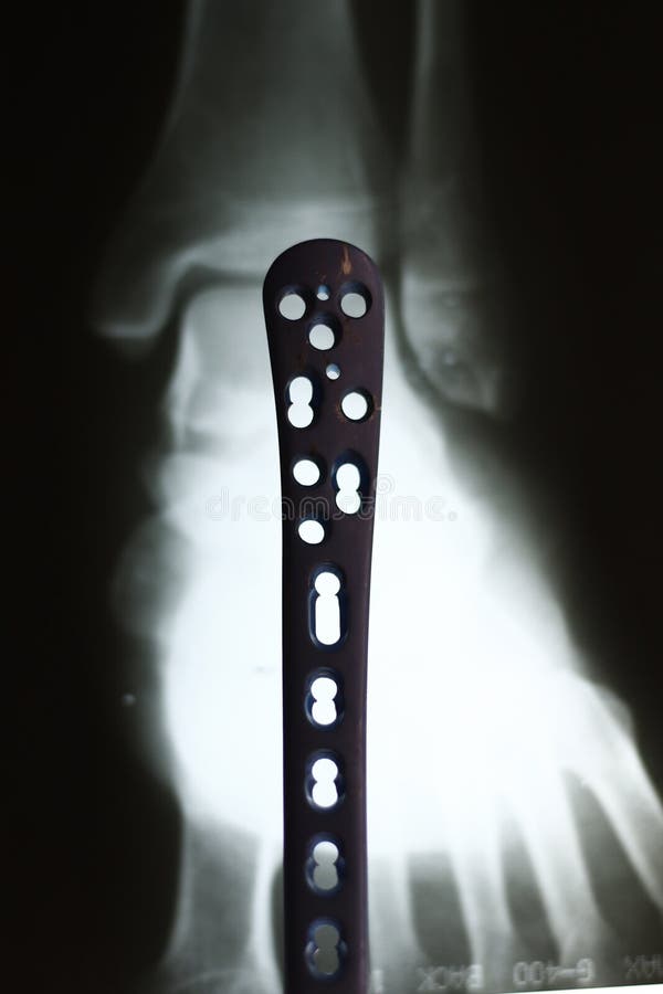 Surgical Instruments in Traumatology for Osteosynthesis of Bone ...