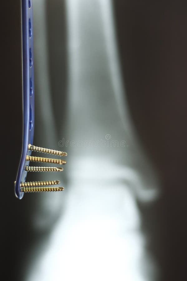 Surgical Instruments in Traumatology for Osteosynthesis of Bone ...
