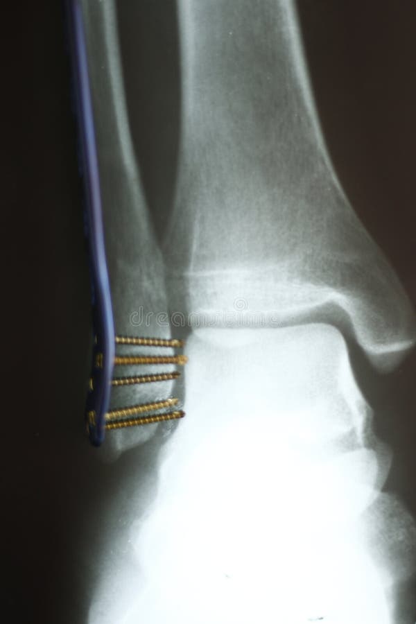 Surgical Instruments in Traumatology for Osteosynthesis of Bone ...