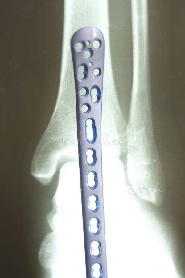 Surgical Instruments in Traumatology for Osteosynthesis of Bone ...