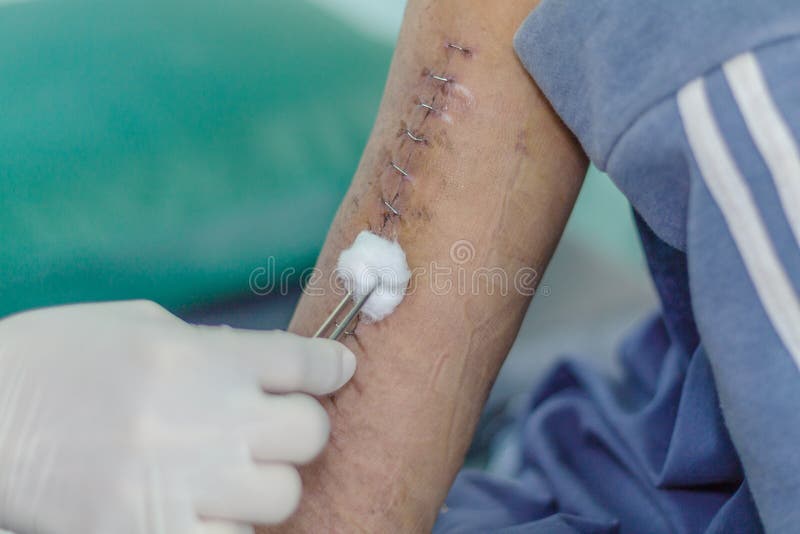 Surgical stapler arm stock photo. Image of theatre, operation - 141133918