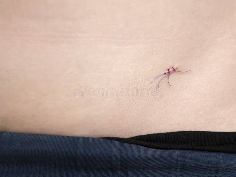 Surgical Suture on the Body. Way of Connecting Tissues of the Body ...