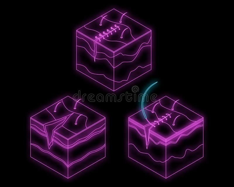 Suture Icons Set Cartoon Vector. Wound Surgical Stock Vector ... Suture Icons Set Cartoon Vector. Wound Surgical Stock Vector ...