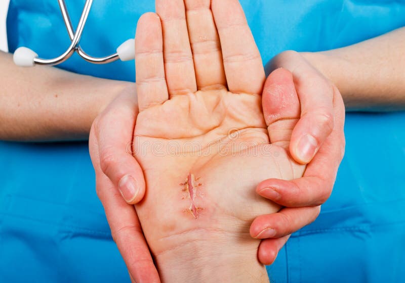 Surgical Suture on Palm of Hand Stock Image - Image of patient, examine ...
