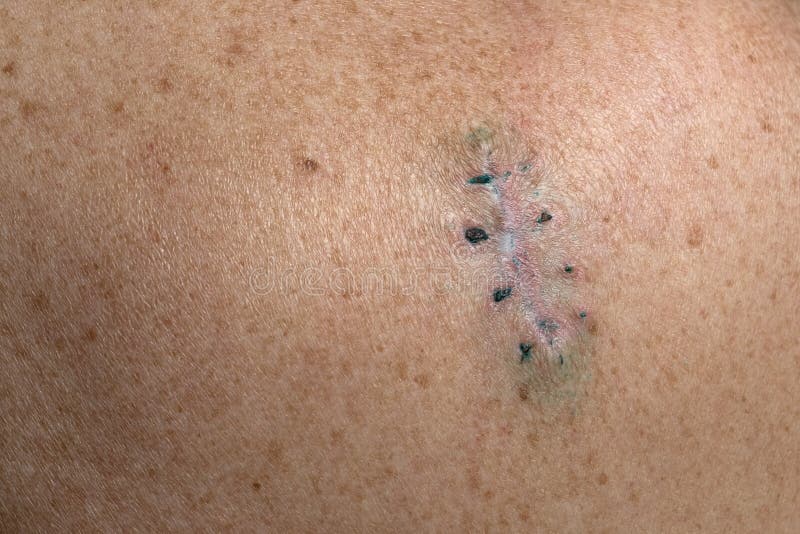 Surgical Suture on the Skin Stock Image - Image of treatment, human ...