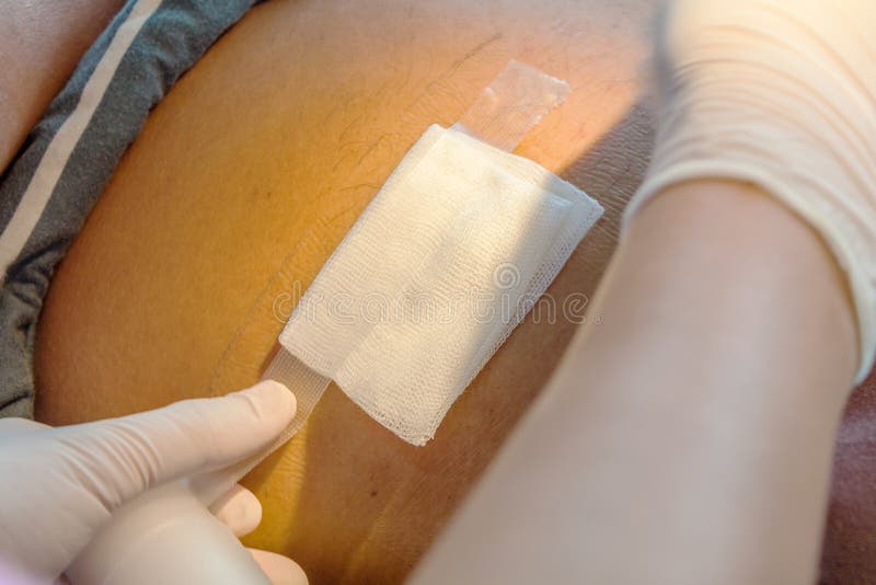 Surgical wound care stock photo. Image of medication - 129965860