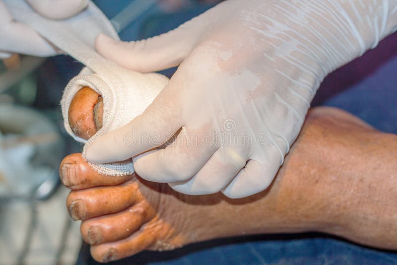 Surgical Wound Dressings, Nursing Care, Safety Caused by Medical ...