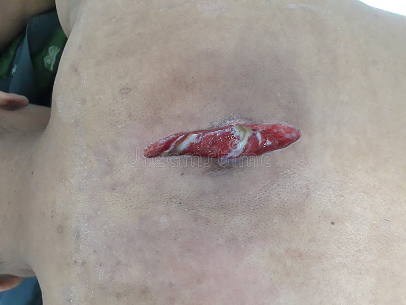 Surgical Wound Large Abscess with Surrounding Cellulitis. Stock Photo ...