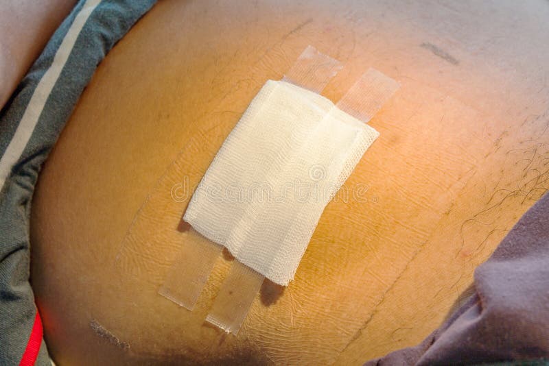 Surgical wound care stock photo. Image of scratch, wound - 129965862