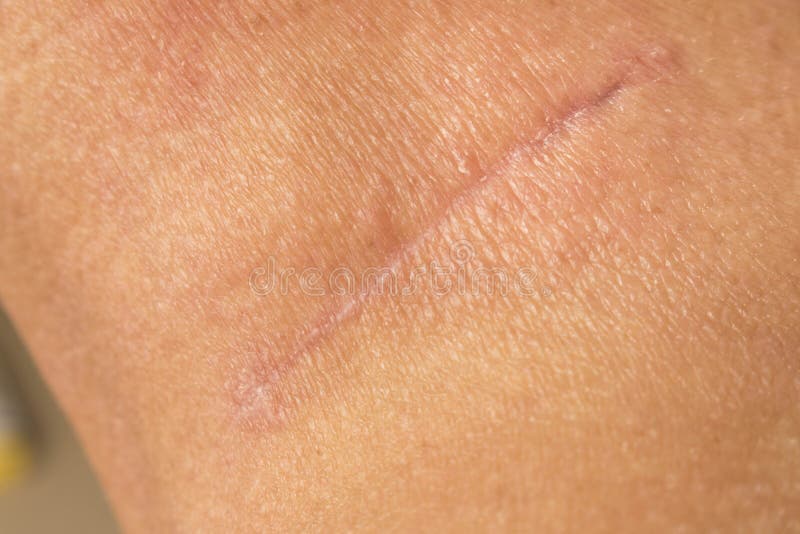 Suture after Surgery on the Human Neck. the Scar after the Surgery ...