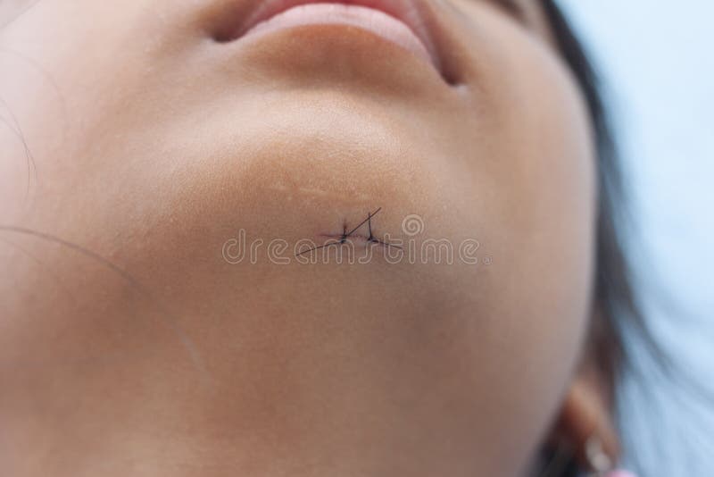 Suture Under the Chin, 2 Needles Due To Chin Fall into the Floor. Stock ...
