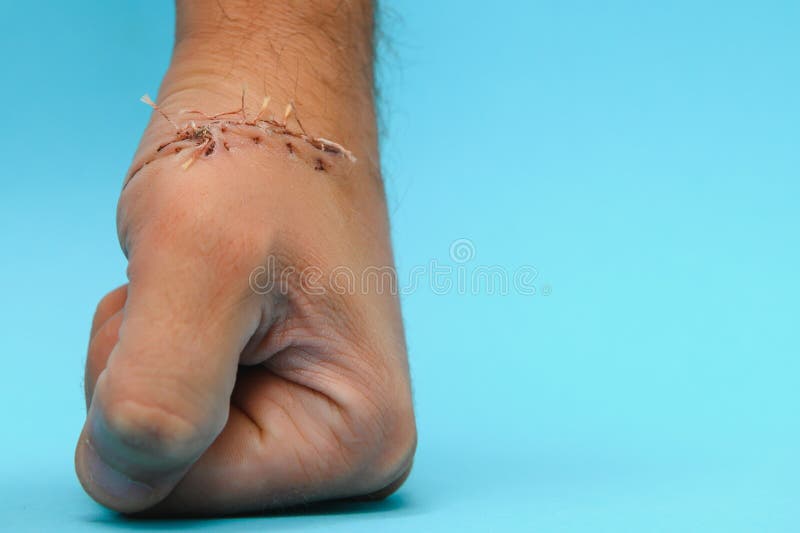 Suture Wound on Hand from Dermatology Procedure Stock Image - Image of ...
