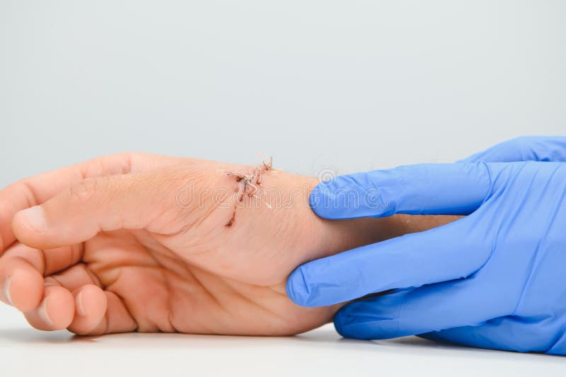 Suture Wound on Hand from Dermatology Procedure Stock Photo - Image of ...