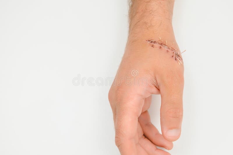 Suture Wound on Hand,Pain of Accident Concept Stock Image - Image of ...
