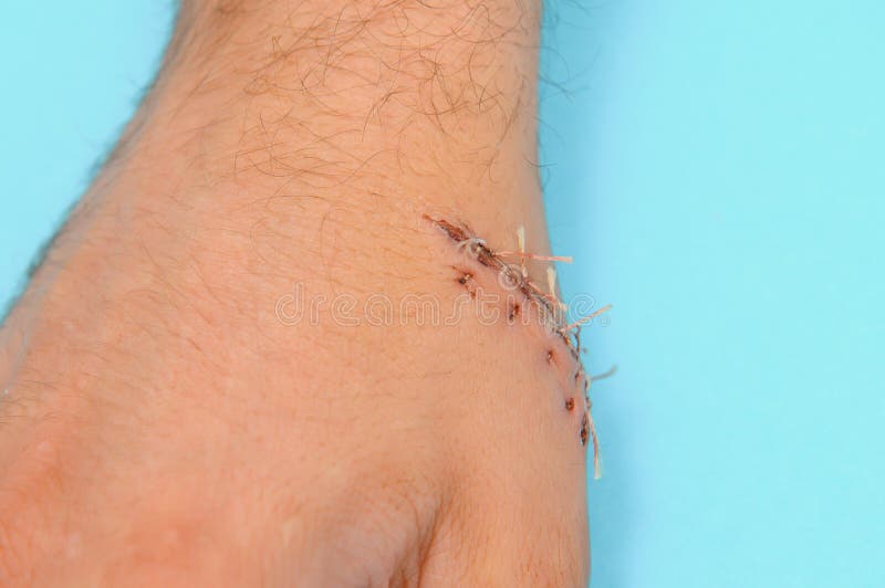 Suture Wound on Hand,Pain of Accident Concept Stock Image - Image of ...