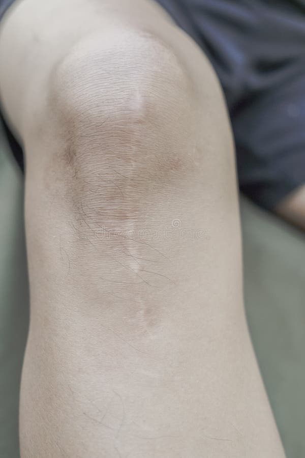 Suture Wound at Knee,knee Surgery Stock Image - Image of skin, pain ...