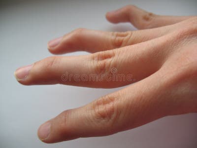 Swan Neck Deformity Hypermobility Stock Image - Image of damage ...