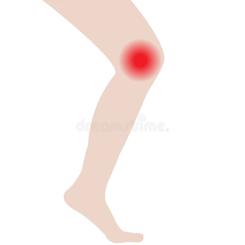 Swelling of the Knee from Infected or Injury Stock Vector ...