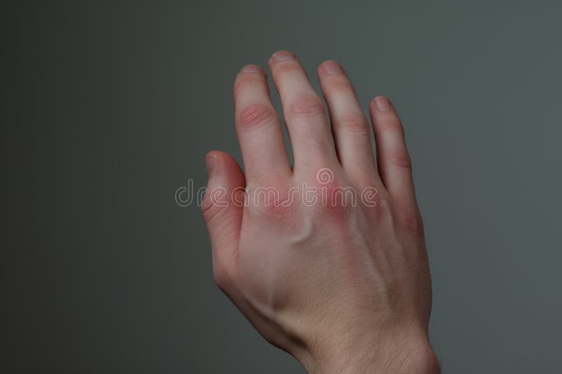 Swollen Finger Joints on Hand, Arthritis Stock Illustration ...