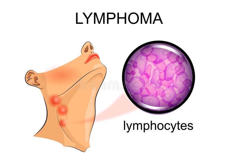 Swollen Lymph Nodes in Lymphoma. Oncology Stock Vector - Illustration ...