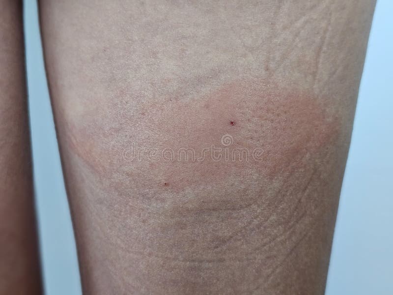 Swollen Skin On The Leg Caused By An Allergic Reaction Or An Insect