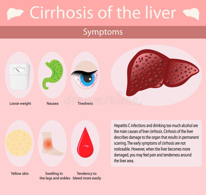 Symptoms of Cirrhosis Oh the Liver. Stock Vector - Illustration of ...
