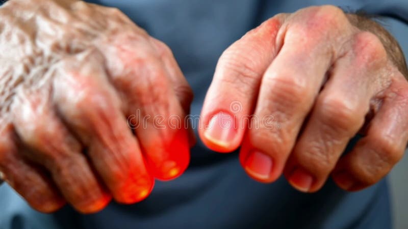 Symptoms of Peripheral Neuropathy in Elderly Hand with Visible Weakness ...