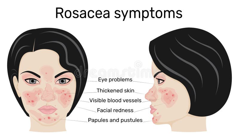 Rosacea Stock Illustrations – 741 Rosacea Stock Illustrations, Vectors ...