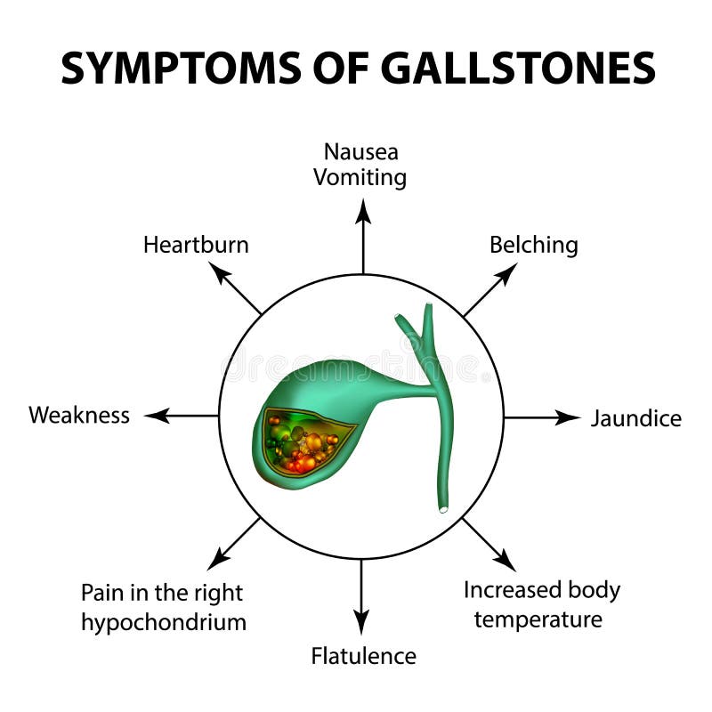 Symptoms of Stones in the Gallbladder. Infographics. Vector ...