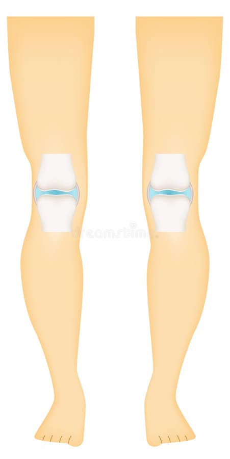 Knee Joint Labeled Diagram stock vector. Illustration of arthritis ...