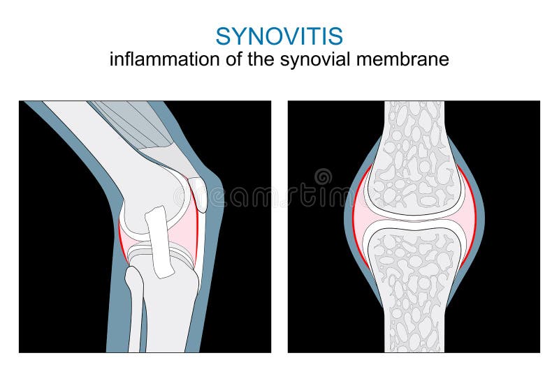 Synovitis. Inflammation of the Synovial Membrane. Knee and Synovial ...