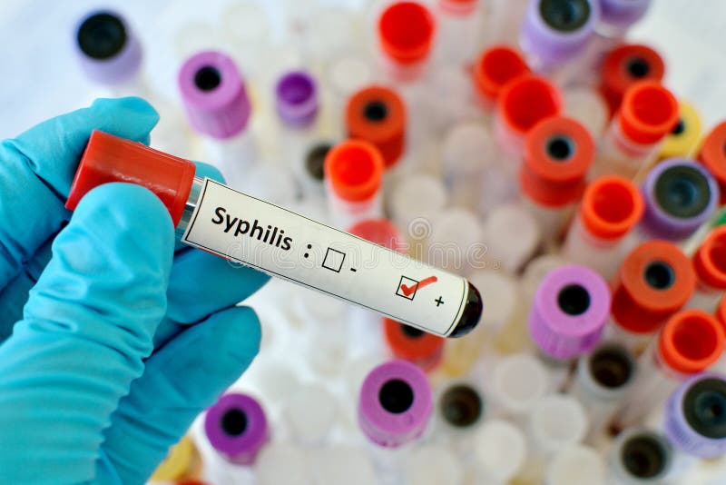 Syphilis positive stock photo. Image of experiment, sick - 55774820