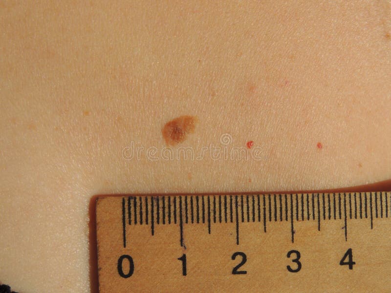 La Tâche De Naissance Sur La Peau Du Milieu a Vieilli L'homme Photo ...