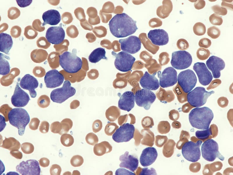 T-cell Acute Lymphoid Leukemia. Bone Marrow. Stock Image - Image of ...
