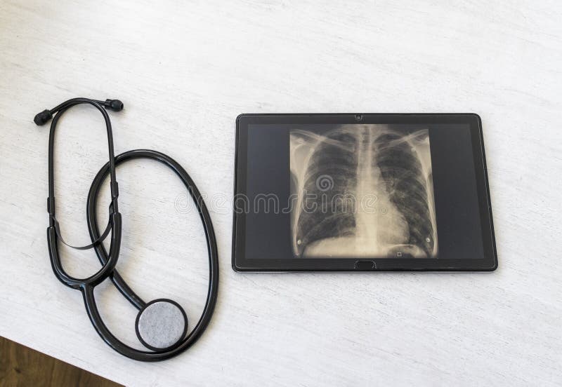 Table with Phonendoscope, and a X Ray Image of the Lungs with Pneumonia ...