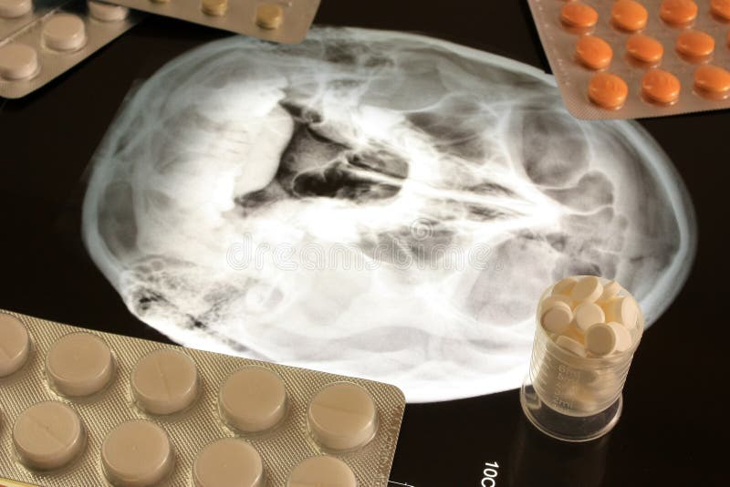 Pills for Treatment and X-ray of the Human Head Stock Image - Image of ...
