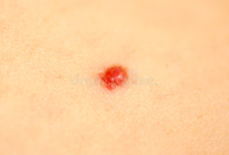 461 Tache Rouge Sur La Peau Photos libres de droits et gratuites de ...