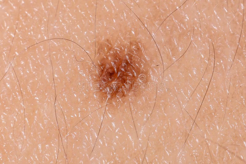 564 Photos de Tache Rouge Sur La Peau - Photos de stock gratuites et ...
