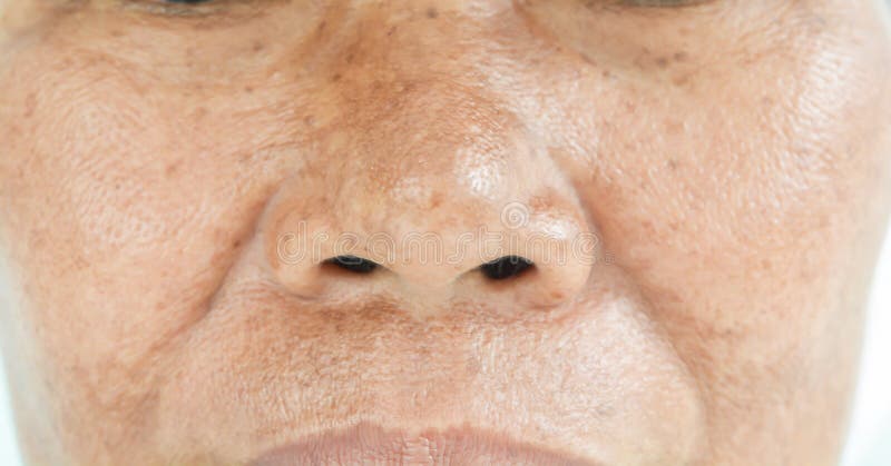 Taches De Rousseur Sur Le Nez Dans Le Visage Image stock - Image du ...
