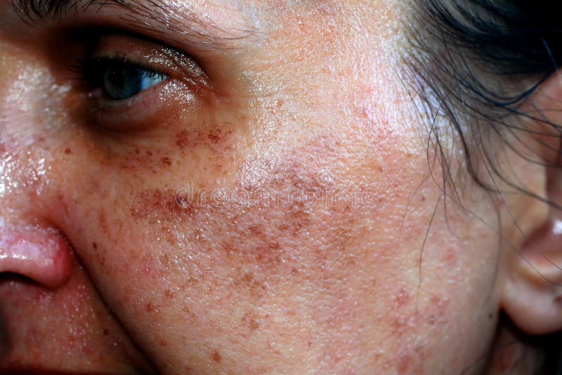 Taches Pigment?es Sur Le Visage Pigmentation Sur Des Joues Image stock ...