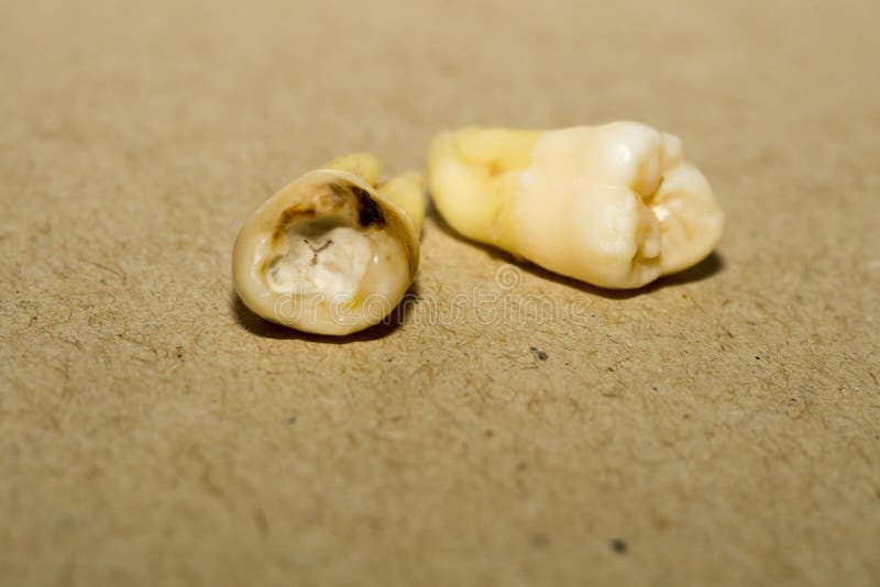 Tand efter extraktion fotografering för bildbyråer. Bild av förfall ...