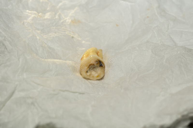 Tand efter extraktion fotografering för bildbyråer. Bild av bruten ...